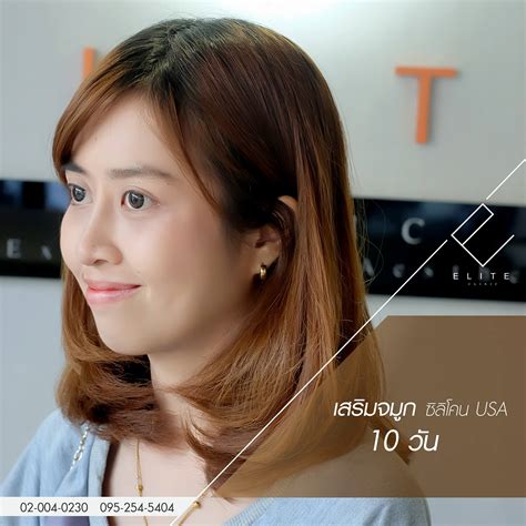 อัพเดทจมูกเสริมใหม่ 10 วันนัดตัดไหมครับ ดูรูปเพิ่มเติมในคอมเม้นนะครับ อัพเดท เสริมจมูก