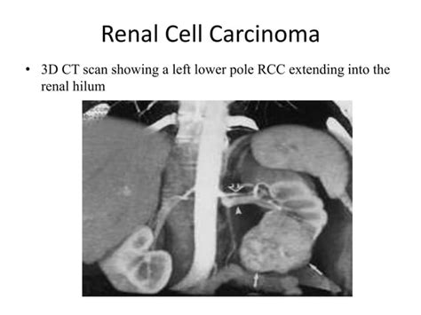 Renal Anatomy And Renal Cell Cancers Pptx
