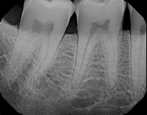 The Short Case Of The Day Tooth Apex Endodontics P C