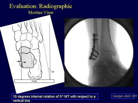 Ankle Fracture Update Ota Resident Core Curriculum Lecture