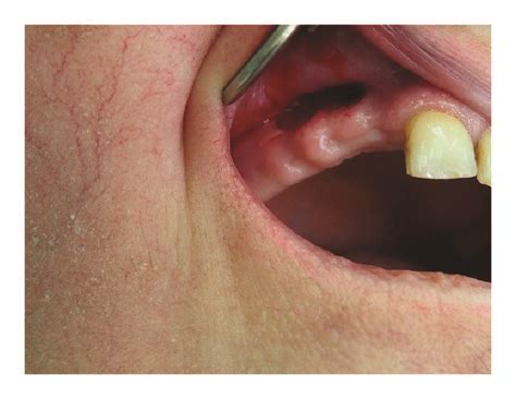 Mronj Stage Iii A Clinical Appearance Of Bone Sequestrum In The