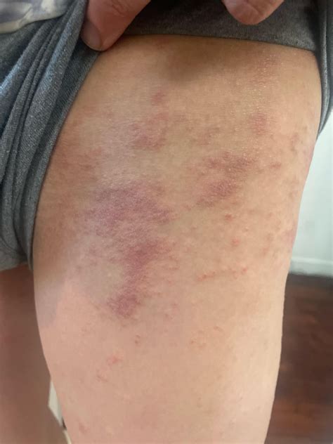 Does This Look Like An Autoimmune Rash R Autoimmune