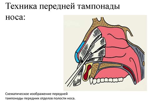 Передняя тампонада носа - презентация онлайн