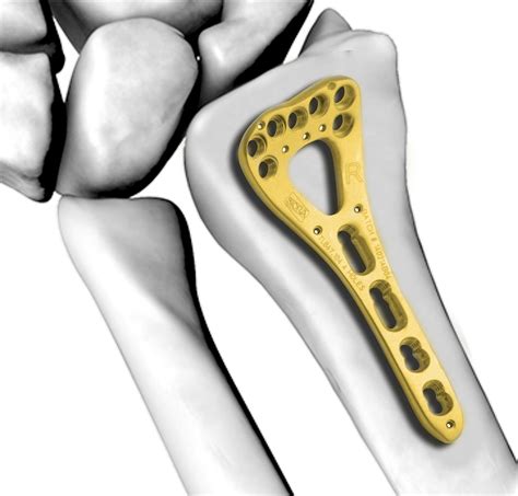 Orthopedic Implants Manufacturer