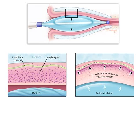Eustachian Tuboplasty Oto Surgery Atlas