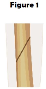 Common Fractures Of The Upper And Lower Limb Flashcards Quizlet