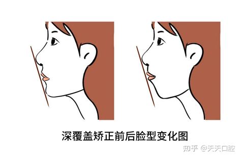 整牙送下巴原来这3种情况下真的可以 知乎