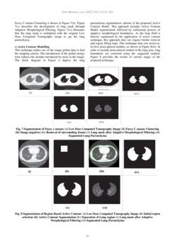 Early Diagnosis Of Lung Cancer Using Computer Aided Detection Via Lung