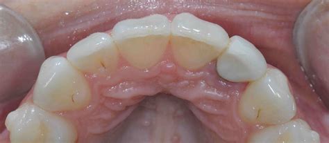 Facial Embrasure Form Web Lee Ann Brady Dmds Dental Blog