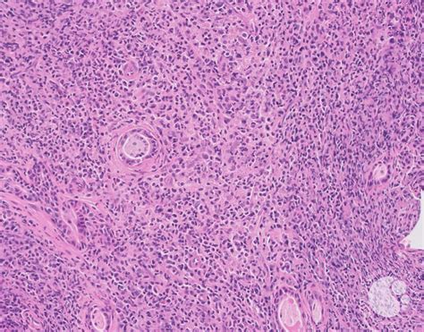 Myeloid Sarcoma Hande