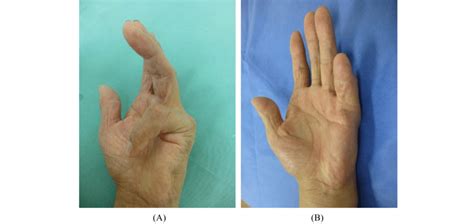 Clinical Findings In Case 2 A Dupuytrens Disease Induced Severe Pip