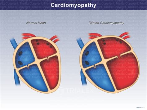 Dilated Cardiomyopathy Ecg