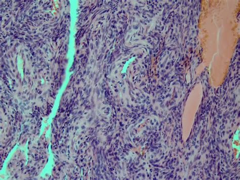 Myopericytoma Tumor