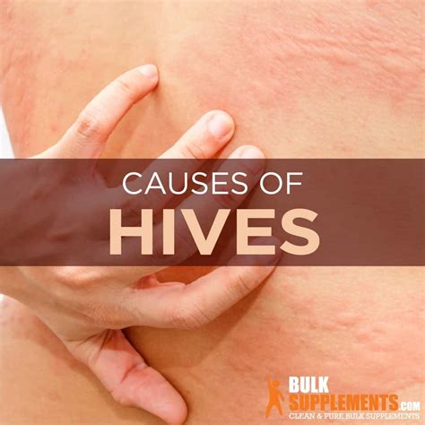 Allergic Reaction Hives Home Remedies