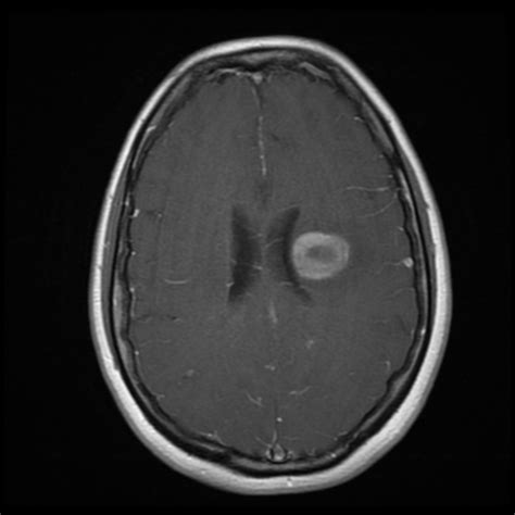 Encephalitis Mri