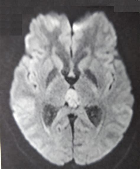 Axial T2 Weighted Magnetic Resonance Imaging Of Brain Showing