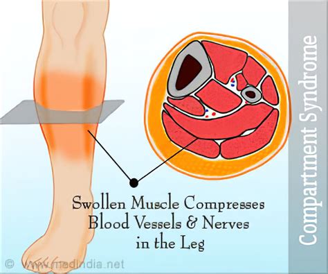 Chronic Exertional Compartment Syndrome Non Surgical Treatment