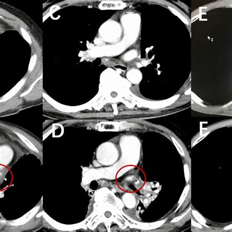 Typical Radiological Findings Of Thrombosis In The Pulmonary Vein Stump Download Scientific