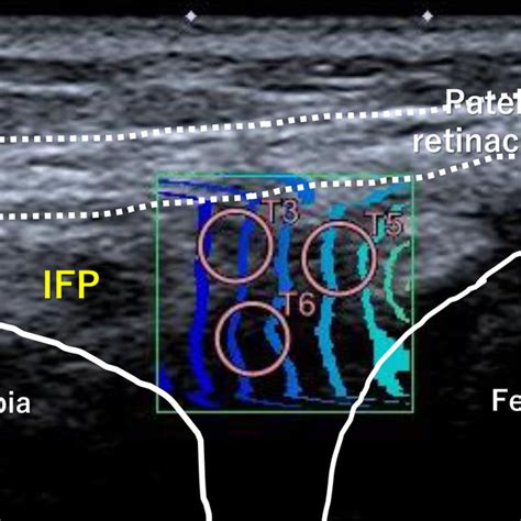 Method Of Measuring Ifp Hardness Via Swe Ifp Infrapatellar Fat Pad