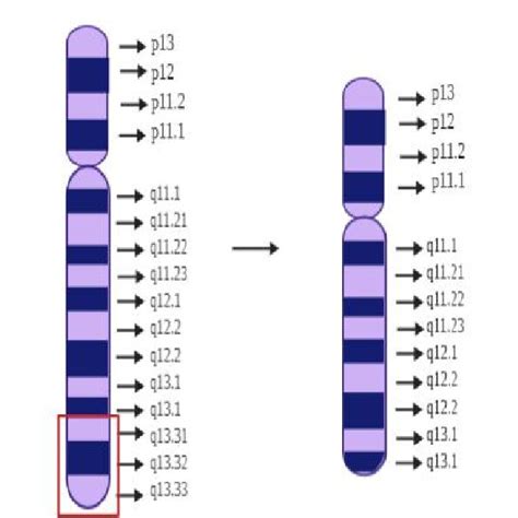 Deleção No Cromossomo 22 Em 22q133 Download Scientific Diagram