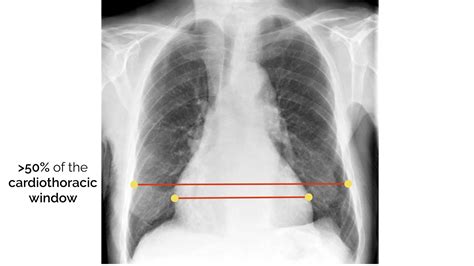 Chest X Ray Pleural Effusion Interpretation