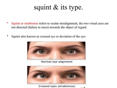Latent Squint Pptx Latent Squint Squint Pptx