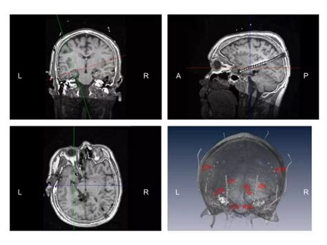 Ictal Eeg Source Imaging Ppt