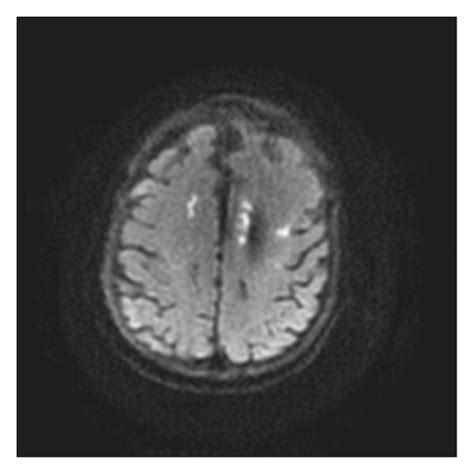 brain mri showing small areas of diffusion restriction with t2