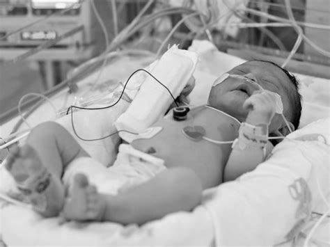 Sepsis Neonatal Image To U