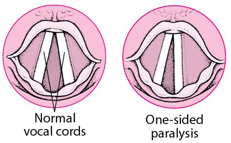 Table Vocal Cord Paralysis Msd Manual Consumer Version