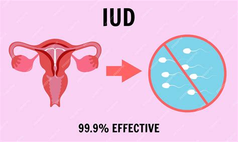 Premium Vector Intrauterine Device Effective Contraception In Vector
