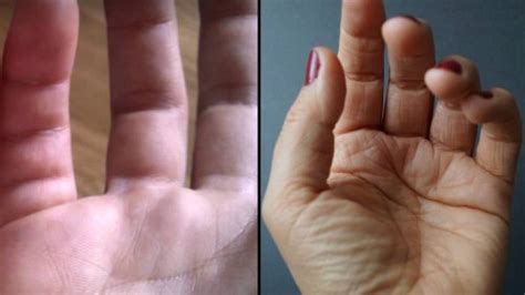 Only A Small Number Of People Have An Extra Crease On Their Pinky