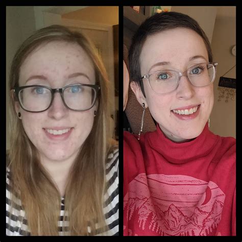 My Appearance While Unknowingly Living With Hiv For 5 Years Vs 2 Years With Treatment Rpics