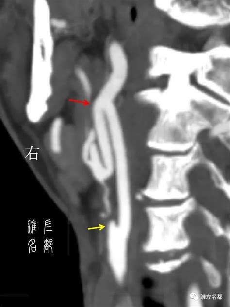 影像读片：颈外动脉变异—开口于颈内动脉 脑医汇 神外资讯 神介资讯