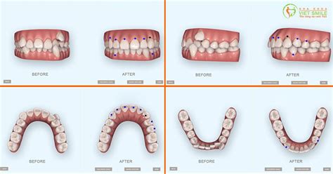 Công Nghệ Scan 3d Xem Trước Kết Quả Niềng Răng