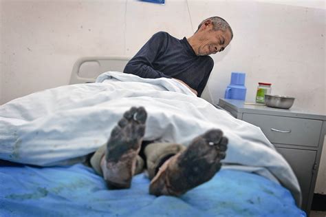 儿童手冻伤图片手冻图片手轻微冻图片大山谷图库