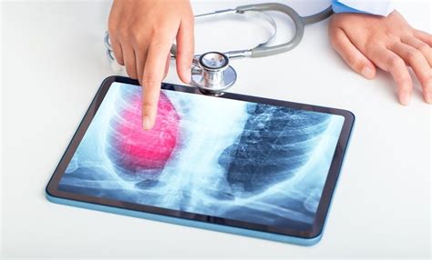 Emj On Linkedin Computer Aided Detection Shows Promise For Tuberculosis Screening