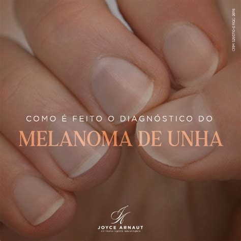 Como é Feito O Diagnóstico Do Melanoma De Unha Dra Joyce Arnaut
