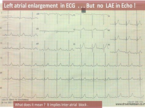 Left Atrial Enlargement In Ecg Drsvenkatesan Md