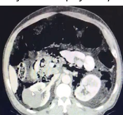 Figure 1 From Management Of Post Endoscopic Retrograde Cholangio