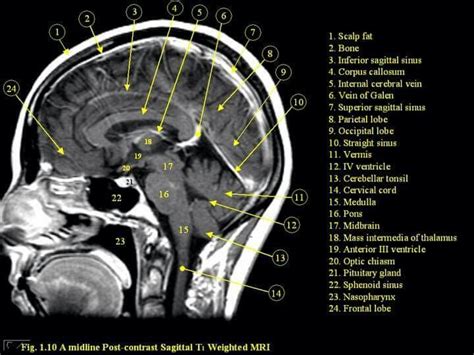 Mri Sagittal Level 01 No Labels
