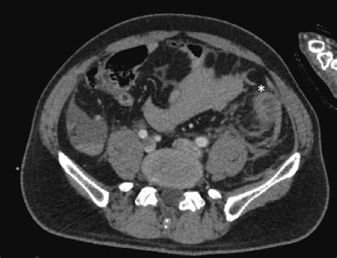 A Case Of Traumatic Mesenteric Bleeding In Which Emergent Surgery Could
