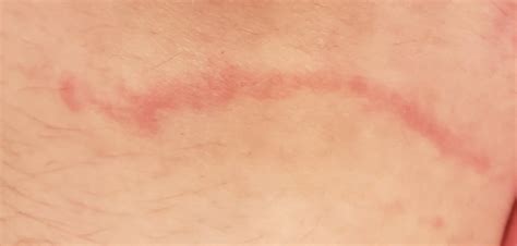 33 M Body Breaking Out In Linear Rashes R Diagnoseme