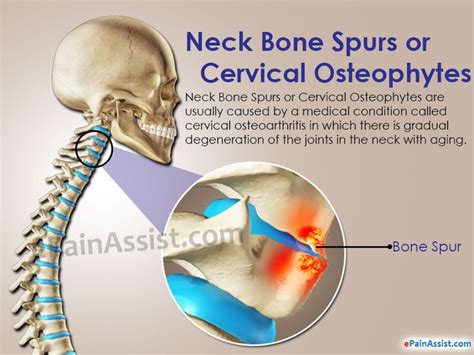 17 Best Images About Bone Spurs In The Neck On Pinterest Bone Bone