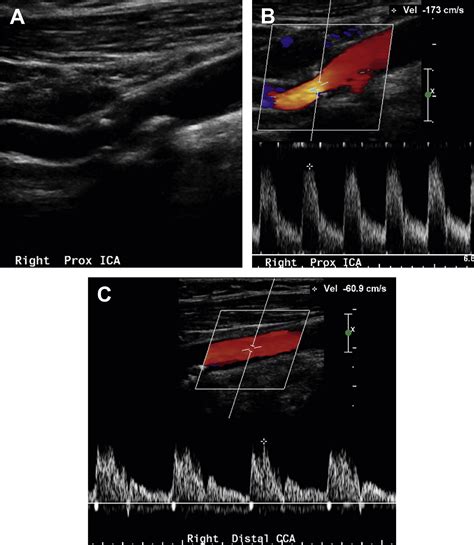 Carotid Ultrasound Radiologic Clinics