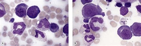 Macrocytic Anemia Basicmedical Key