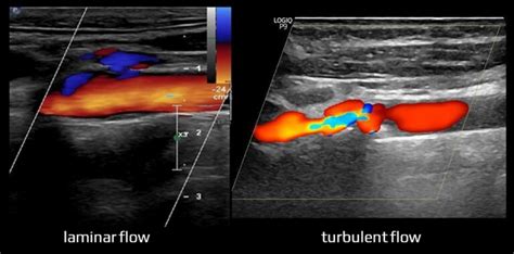 Etiologic Classification Of Ischemic Stroke Stroke Manual