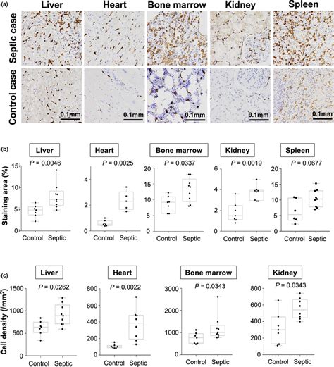 Immunohistochemical Analysis Of Cd163 Expression A Cd163 Expression