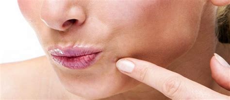Facial Warts Can Be Truly Scary Women Daily Magazine