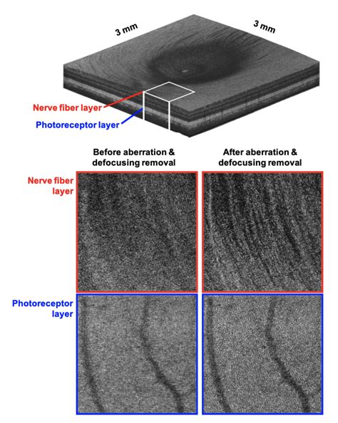 Wide Field Three Dimensional Depth Invariant Cellular Resolution Imaging Of The Human Retina